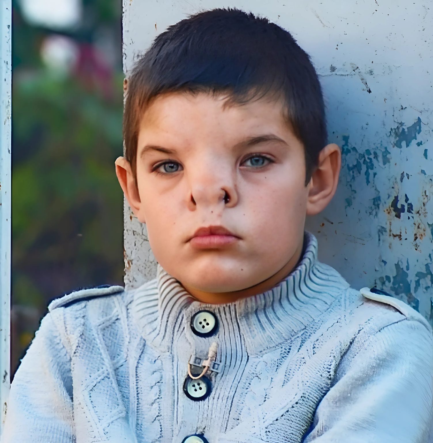 Born With a Rare Nose Condition, Sergei’s Transformation Stuns Everyone ...